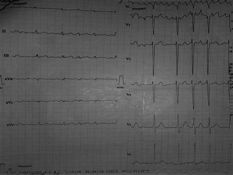 What Is Atrial Flutter With Variable A V Block At Jackson Dunrossil Blog