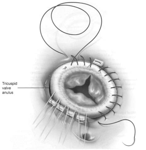 Tricuspid Valve Replacement Operative Techniques In Thoracic And