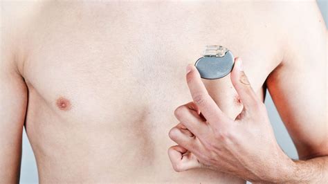 Имплантируемый кардиовертер дефибриллятор установка настройка