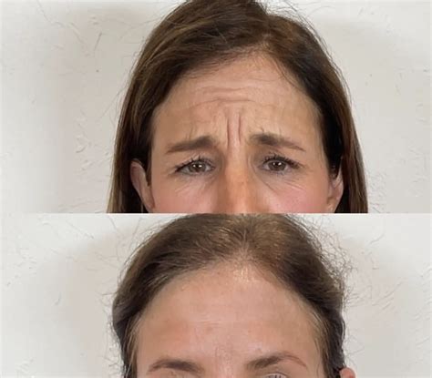 Tox Before And After Images Lou Lou Med Spa