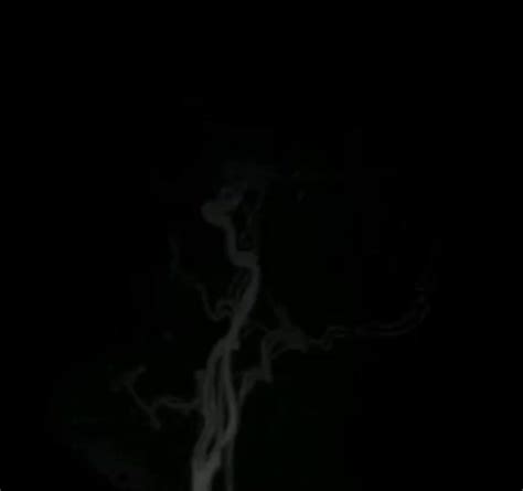 Mri Brainaneurysm Twistsequence Neuroimaging Medicalimaging… Iman Afshar