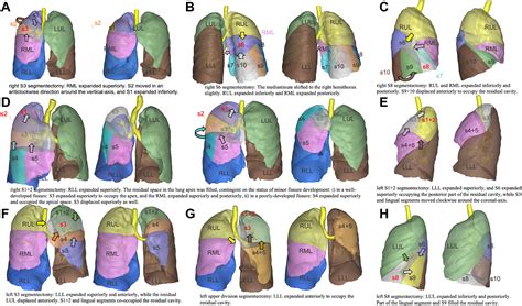 Pulmonary Function Recovery And Displacement Patterns After Anatomic Segmentectomy Vs Lobectomy