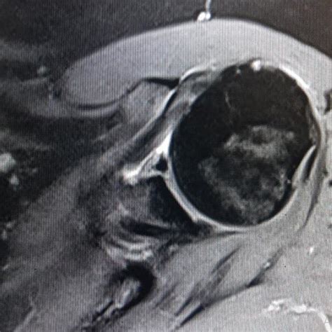 Axial Mri Shoulder Image Revealing Anterio Inferior Labral Tear