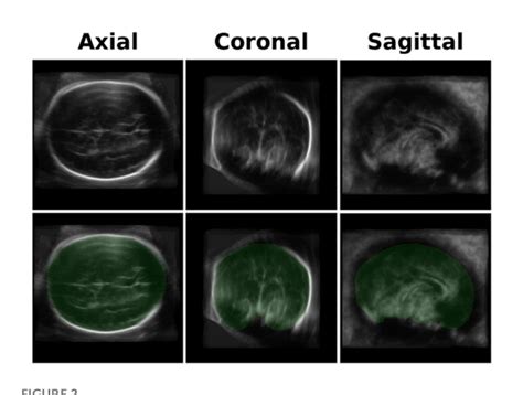 Figure 1 From Automatic Measurements Of Fetal Intracranial Volume From 3d Ultrasound Scans