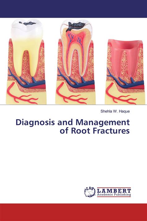 Diagnosis And Management Of Root Fractures 978 613 9 99568 4