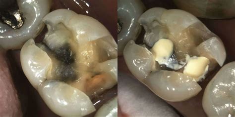Pulp Capping A Vital Dental Treatment