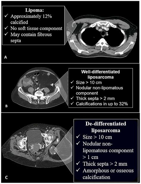 Pictorial Review Of Soft Tissue Lesions With Calcification