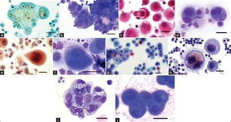 Guidelines For Cytopathologic Diagnosis Of Epithelioid And Mixed Type
