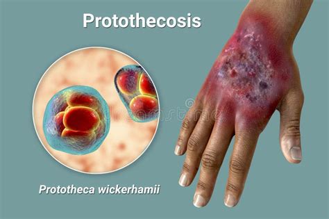 Protothecosis Infection On Human Hand And Close Up View Of Prototheca Wickerhamii Green Algae