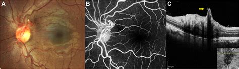 Type Vi Prepapillary Arterial Vascular Loop Ophthalmology Retina