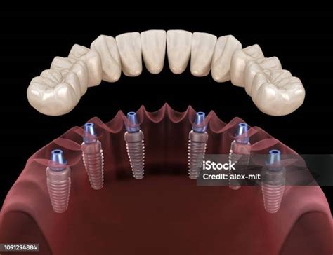 임 플 란 트에 의해 지원 6 시스템에 모두의 악의 족 인간의 치아와 의치 개념의 의학으로 정확한 3d 그림 치아 임플란트에