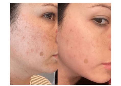 Rf Microneedling Long Island New York Vybe Rf