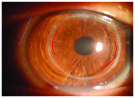 Astigmatic Keratotomy
