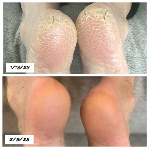 Heel Balm Testimonials Tropical Tallow