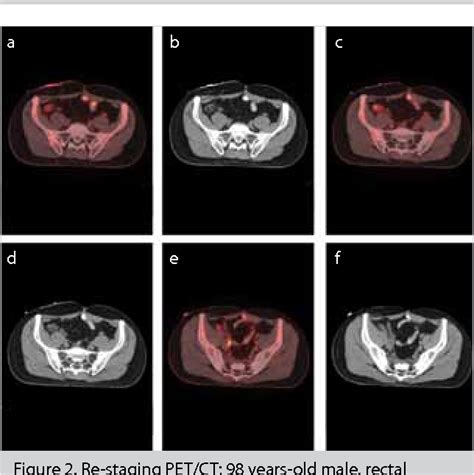 Pet Scan Colon Cancer