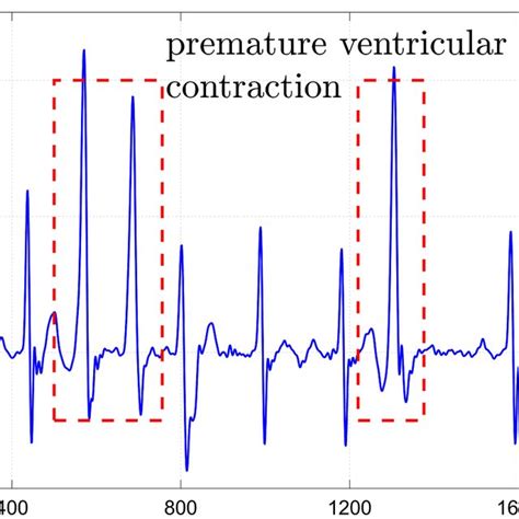 Pdf Fusing Transformer Model With Temporal Features For Ecg Heartbeat Classification