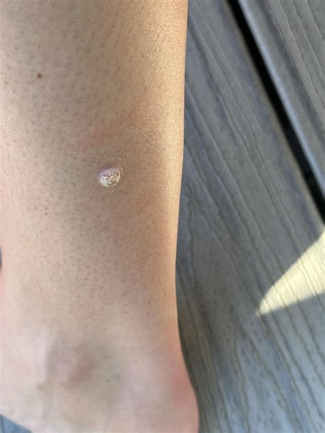 Keloid Scar Wart Something Else R Warts