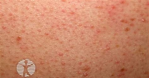 Pityrosporum Folliculitis Image