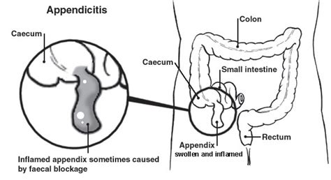 Inflamed Appendix