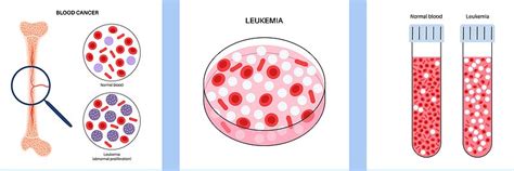 Tipos De Leucemia