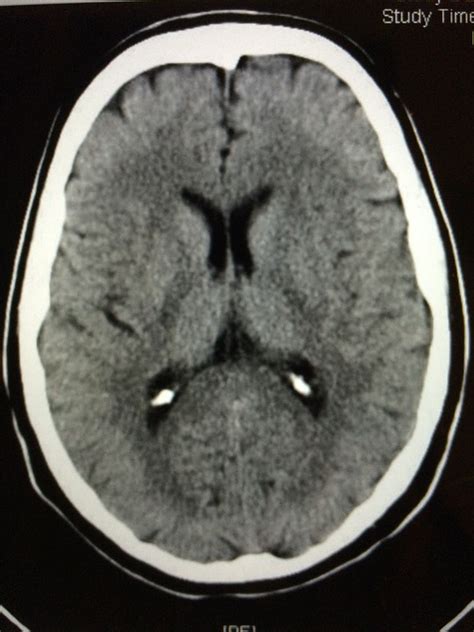 Brain Ct Scan Normal Free Photo On Pixabay