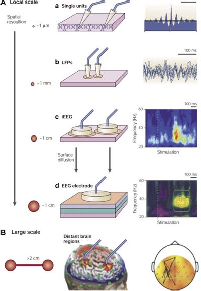 What Electrophysiology Tells Us About Alzheimers Disease A Window Into The Synchronization And