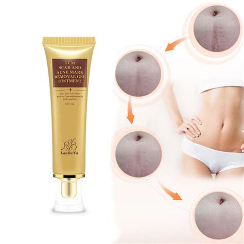 30 г крем для удаления акне и шрамов кожи отбеливающий крем для лица Прыщи шрамы беременность