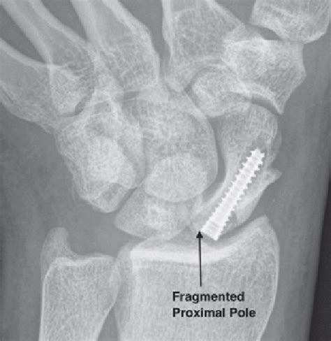1 Preoperative X Ray Demonstrating Lucency Around The Screw With Screw Download Scientific