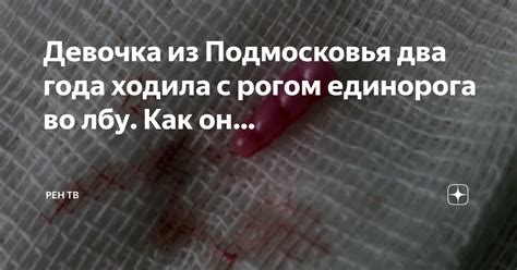 Девочка из Подмосковья два года ходила с рогом единорога во лбу. Как он ...