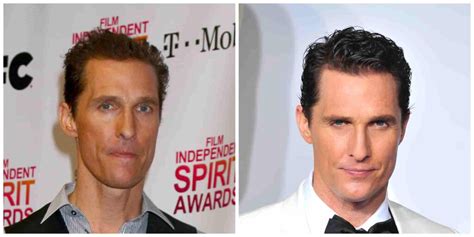 Matthew Mcconaughey Hair Transplant The Truth Revealed