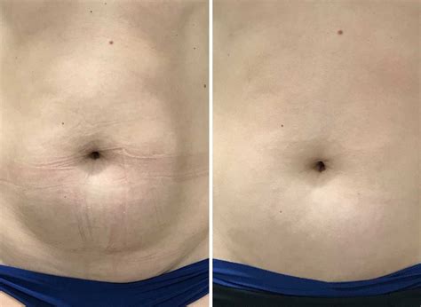 Radiofrequency Skin Tightening Skin Lifting Skin Doctor Clinics