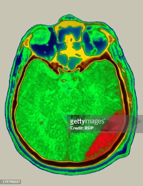 178 Hematoma Photos And High Res Pictures Getty Images