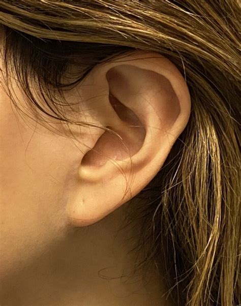Left Pixie Ear Deformity After Facelift Dr Barry Eppley Explore Plastic Surgery