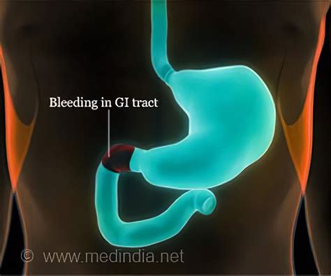 Upper Gi Bleed