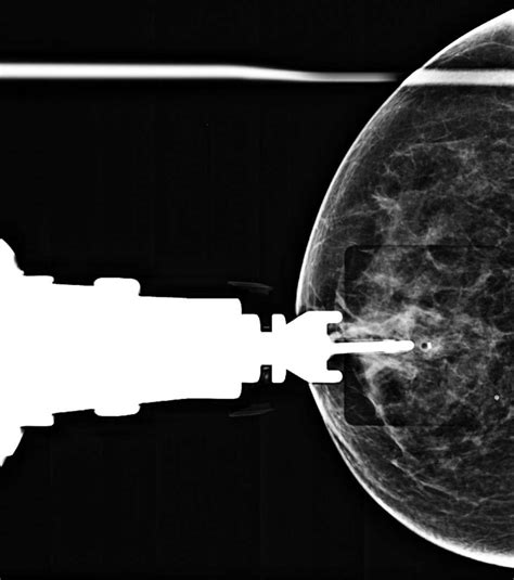 How To Perform Stereotactic Mammographic Guided Biopsy Radiology Ucla Health