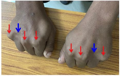 Pseudohypoparathyroidism Type 1a Manifested With Tetany A Rare Case Scenario