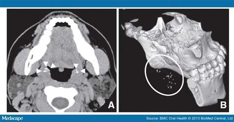 Tonsilloliths On Ct And Panoramic Radiographs Page 4