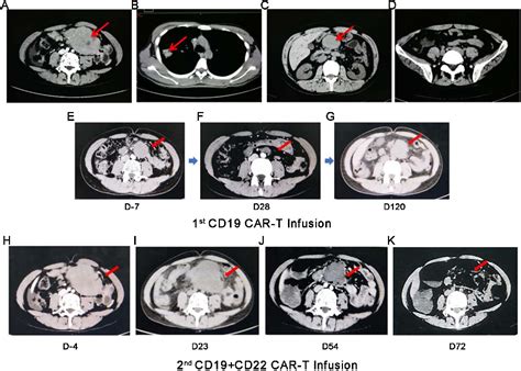 Figure 4 From Dual Specific Cd19 Cd22 Targeted Chimeric Antigen Receptor T Cell Therapy For