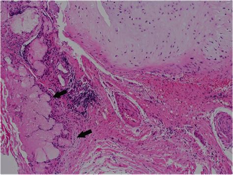 A Case Report Of Chondrocalcinosis Of The Temporomandibular Joint Surgical Management And