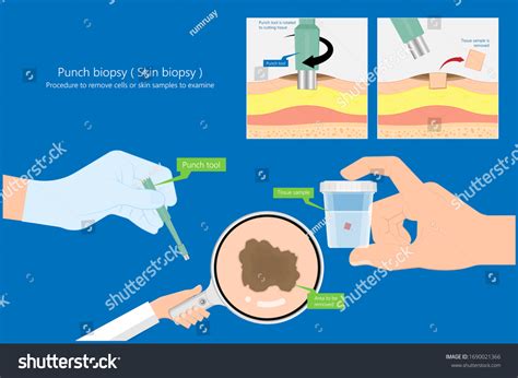 Skin Biopsy Test Over Royalty Free Licensable Stock Illustrations Drawings Shutterstock
