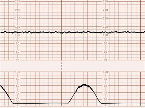 105 Fetal Heart Rate Monitoring Medicine Libretexts