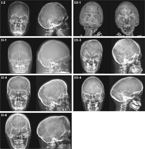 Lambdoid Suture X Ray