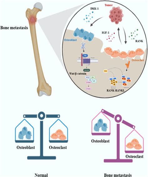 Research Progress Of Bone Metastases From Disease Recognition To