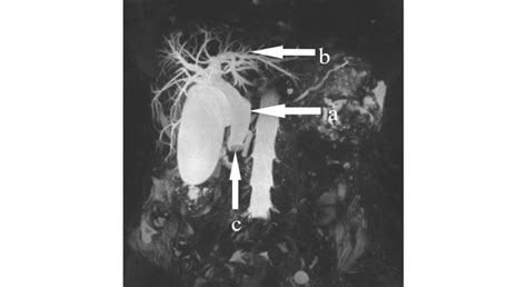 Magnetic Resonance Cholangiography Imaging Of A Patient Before