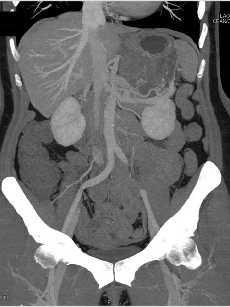 Exophytic Gastric Gist Tumor Stomach Case Studies Ctisus Ct Scanning