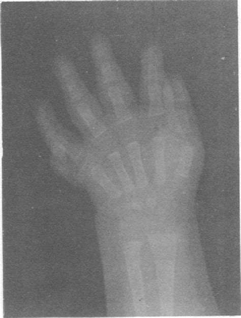 X Ray Ofleft Hand Showing Postaxial Polydactyly And Normal Thumb