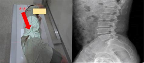 L Spine Ap Obl Lat Motion Home