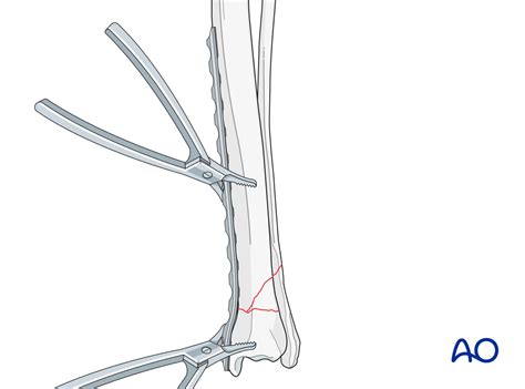 Neutralization Plating Plate And Lag Screw For Extraarticular Wedge