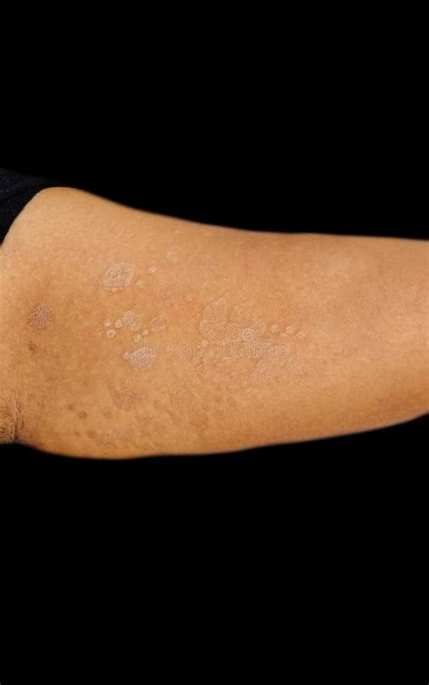 Psoriasis Skin Condition On Upper Arm Stock Image Image Of Fungus