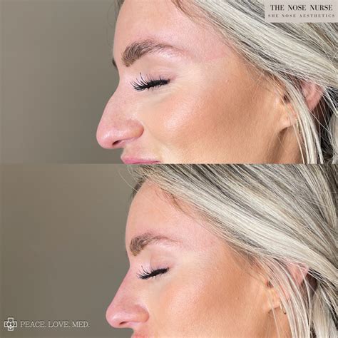 Non Surgical Nose Job Nose Job Rhinoplasty Nose Jobs Nose Fillers